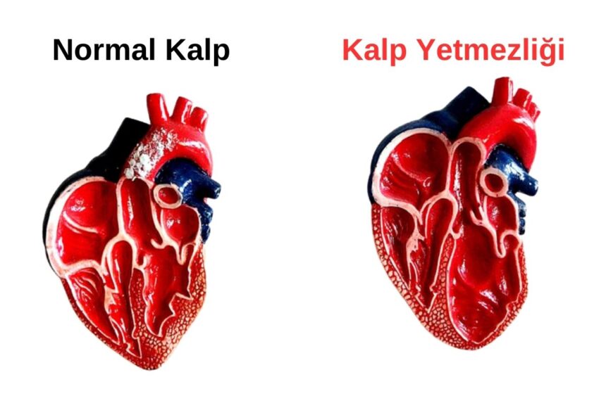 Kalp Yetmezliğine Genel Bakış - Simbians